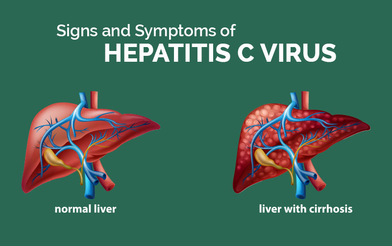 Most Reviewed Anti HCV Test In Budget Cost In Kolkata Accuhealth Most Reviewed Anti HCV Test In Budget Cost In Kolkata Accuhealth